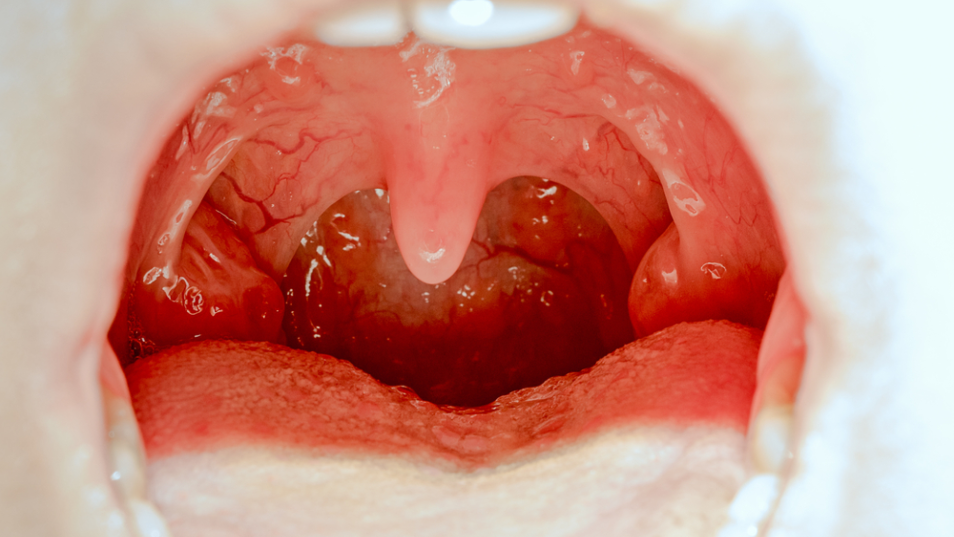 Viêm amidan lưỡi: Nguyên nhân, biến chứng nếu không điều trị