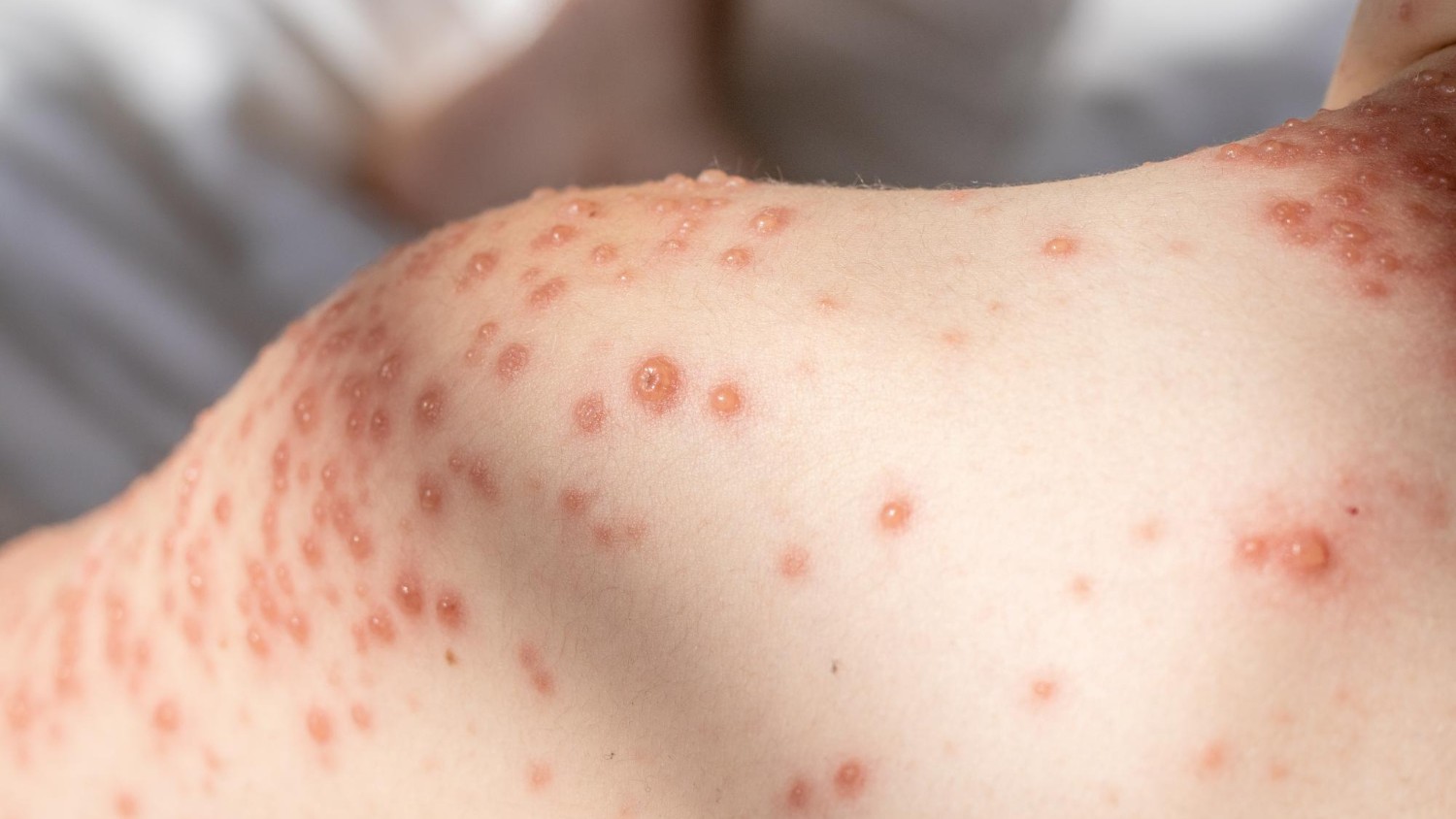 U mềm lây là gì? Triệu chứng, nguyên nhân, cách điều trị và phòng ngừa ...