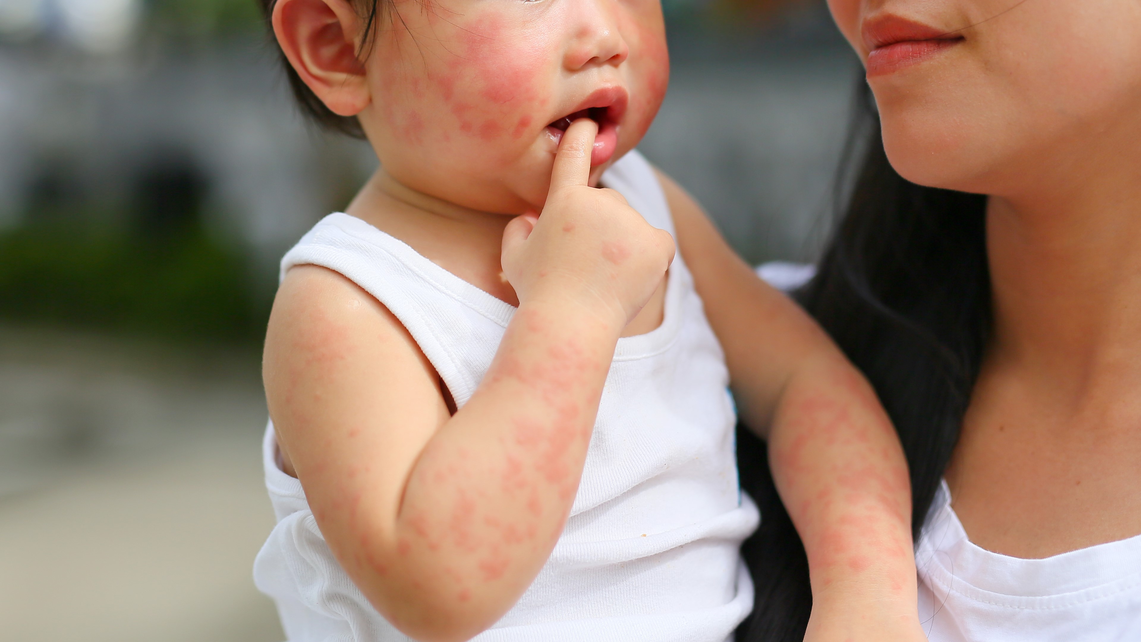 Bệnh sởi: Triệu chứng, nguyên nhân, chẩn đoán và điều trị