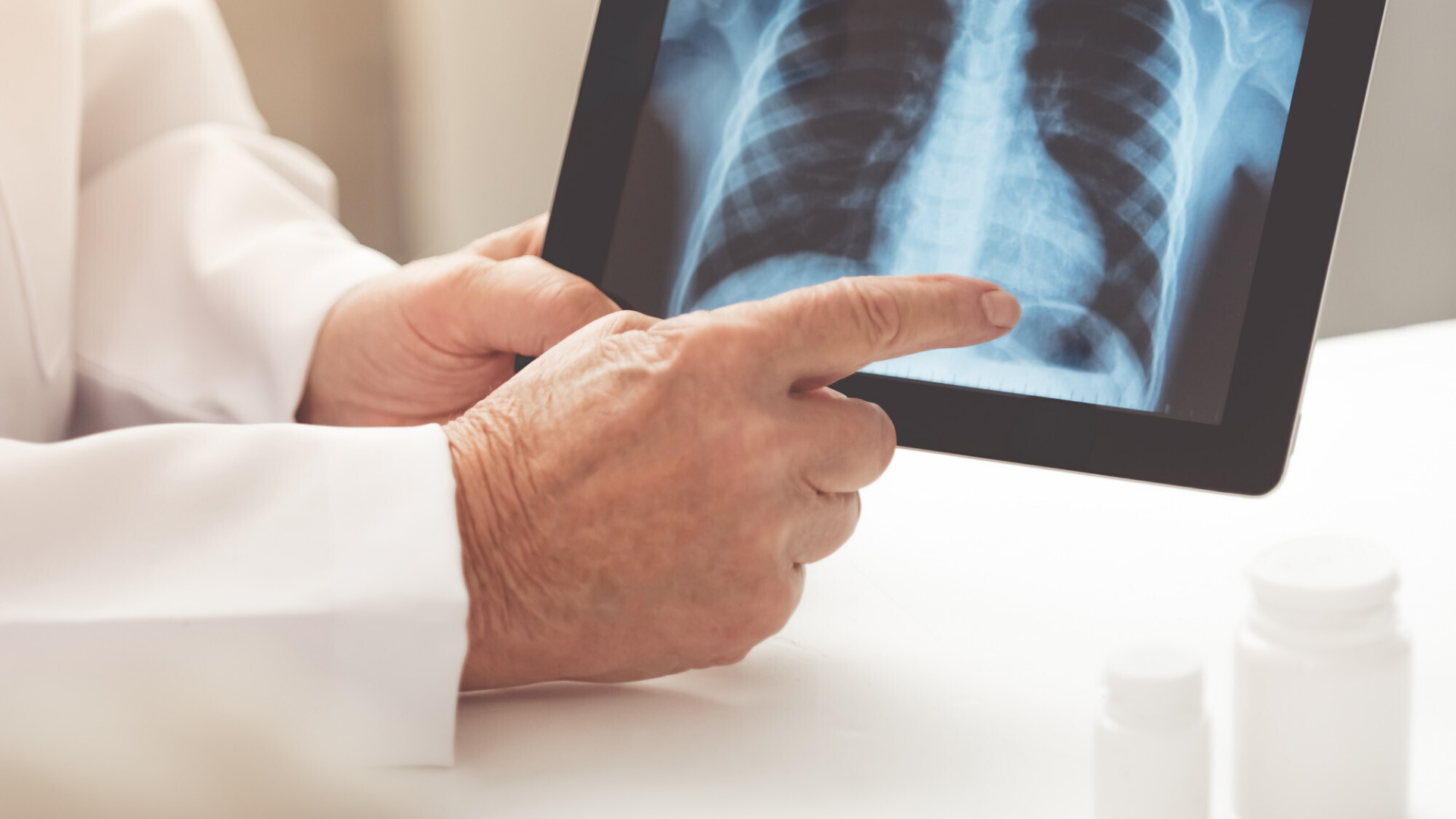 Định nghĩa viêm phổi và các tiêu chuẩn chẩn đoán viêm phổi