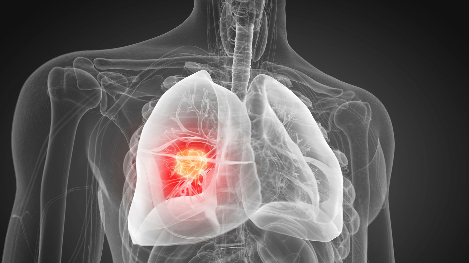 Chỉ số CA 125 tăng trong trường hợp nào? Các yếu tố ảnh hưởng đến nồng ...