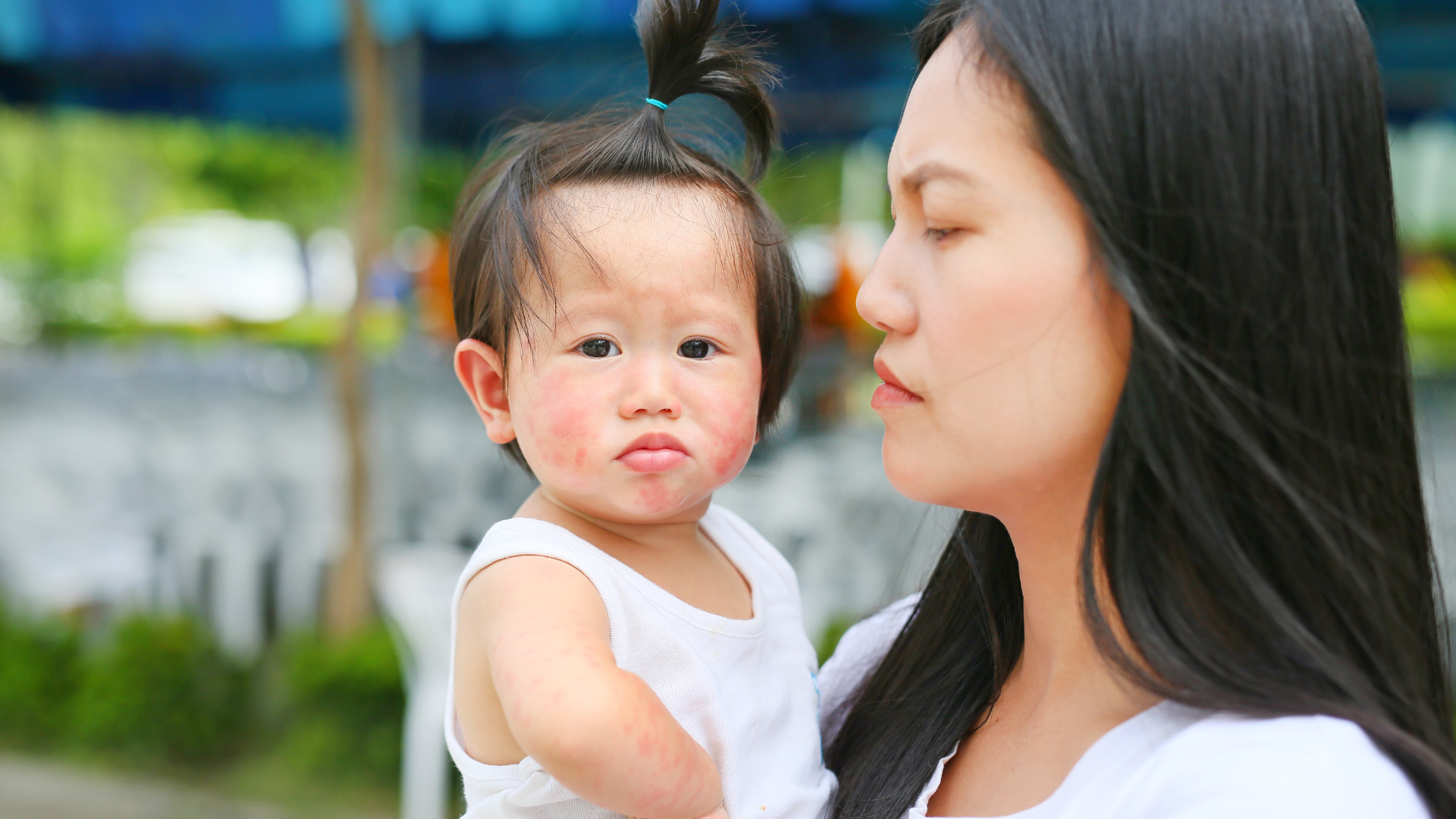 Da nổi chấm đỏ như nốt ruồi son không ngứa : 8 nguyên nhân chính