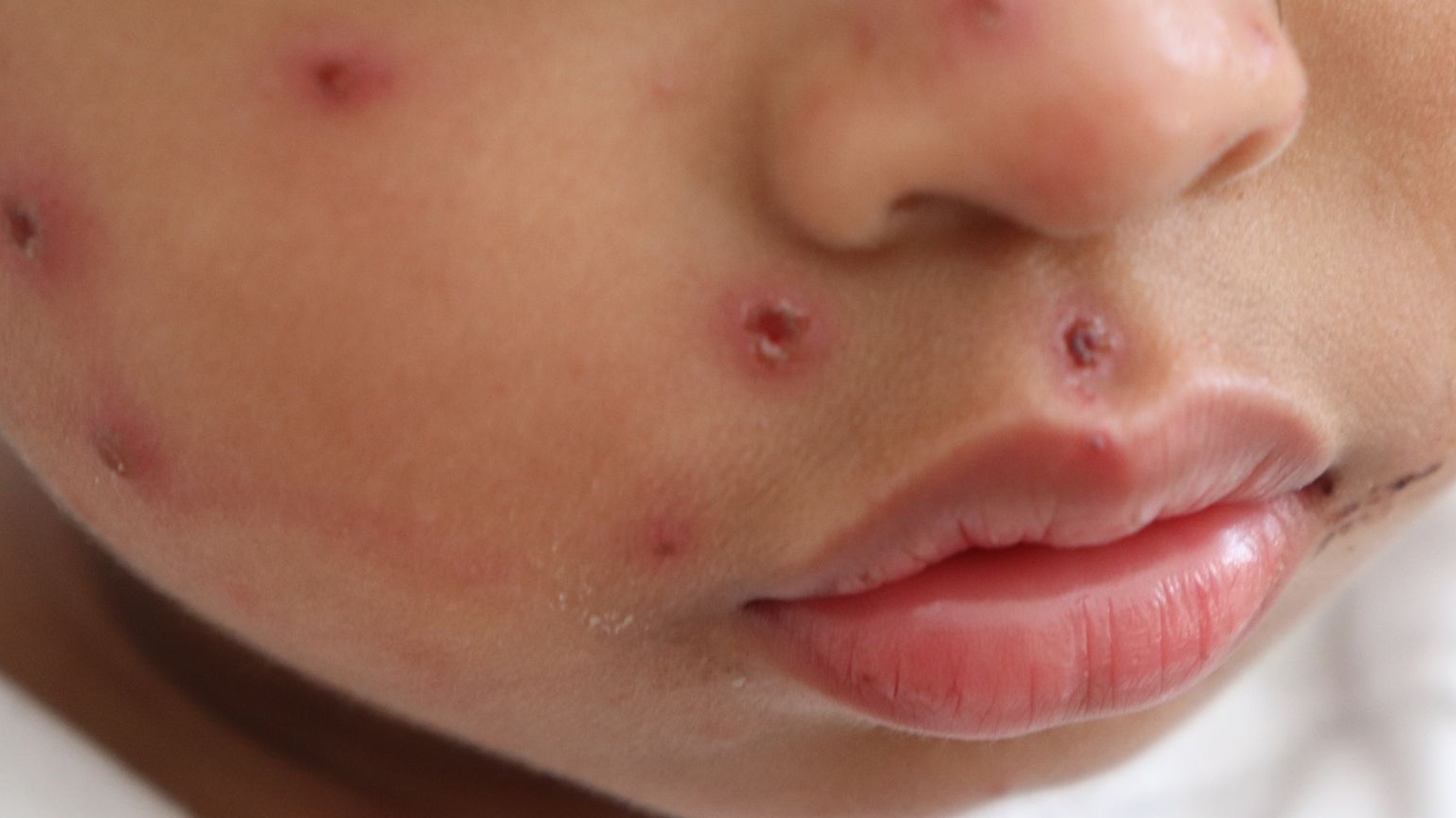 Dấu hiệu bệnh sởi ở trẻ dưới 1 tuổi: Nguyên nhân và điều trị