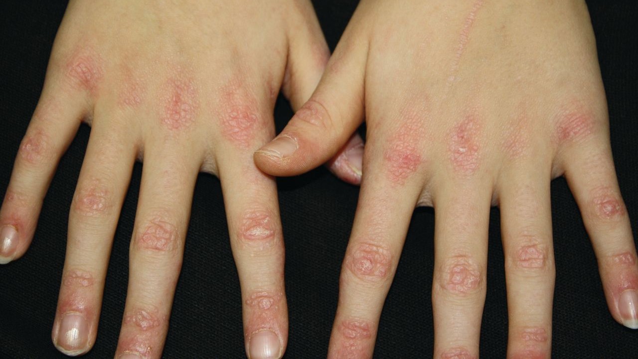 Sẩn gottron là gì? Triệu chứng và nguyên nhân gây bệnh - Trung tâm Tiêm ...