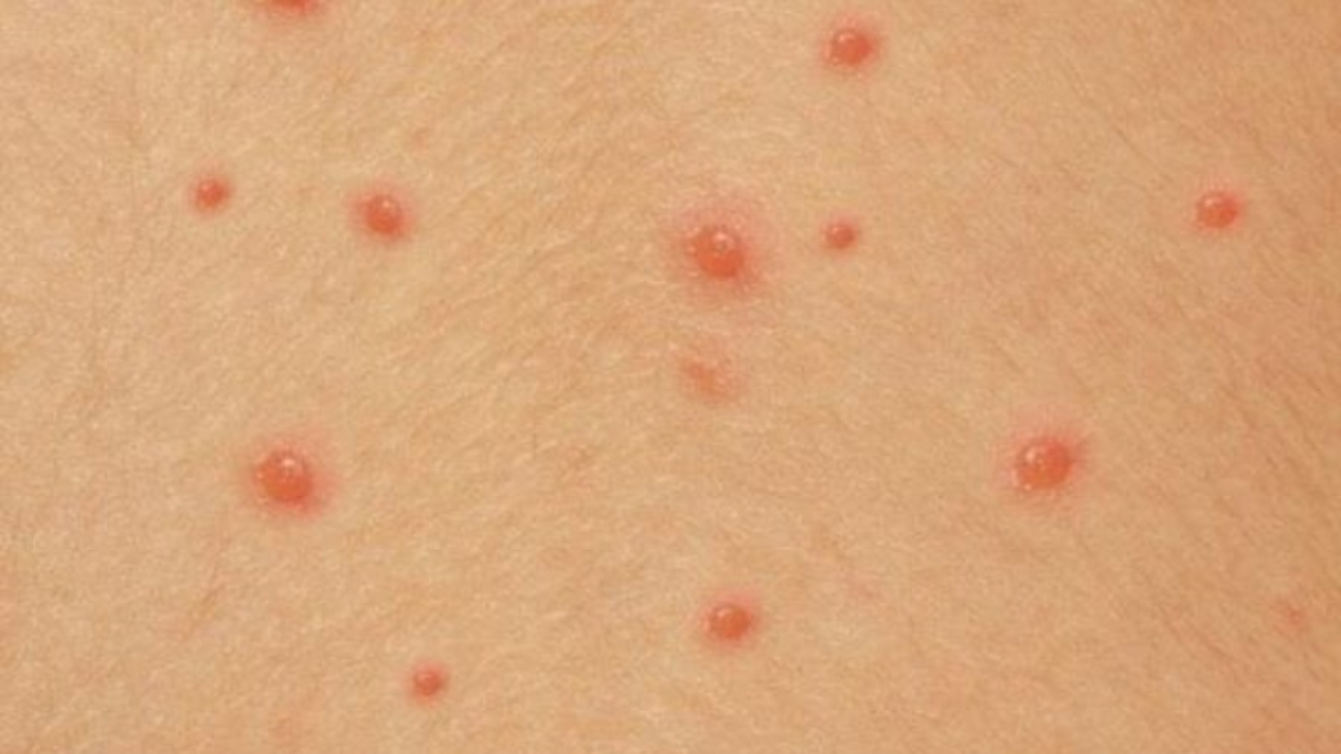 U mềm lây có tự khỏi không? Nguyên nhân gây bệnh u mềm lây