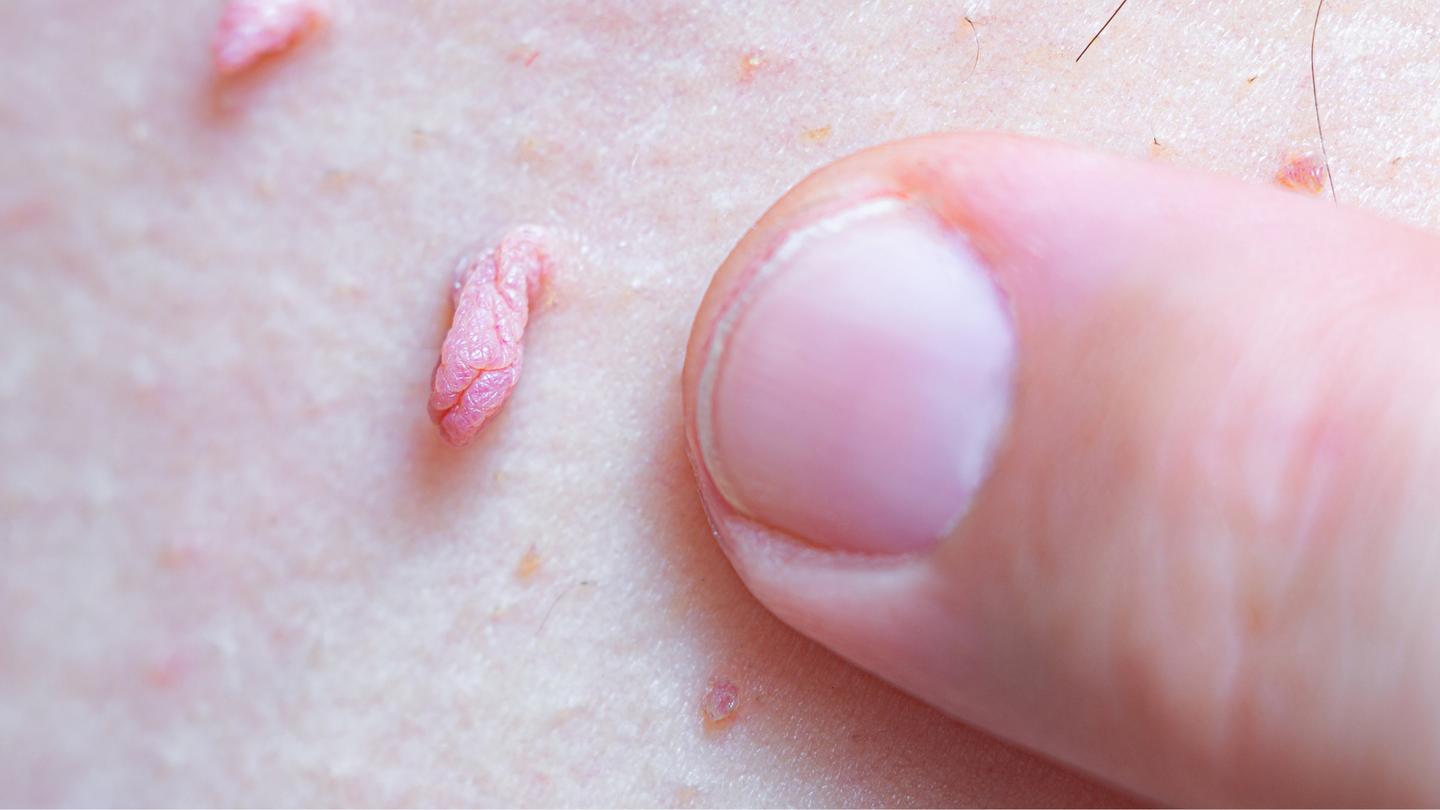 Dấu hiệu nhiễm HPV ở nam giới và lây qua những con đường nào?