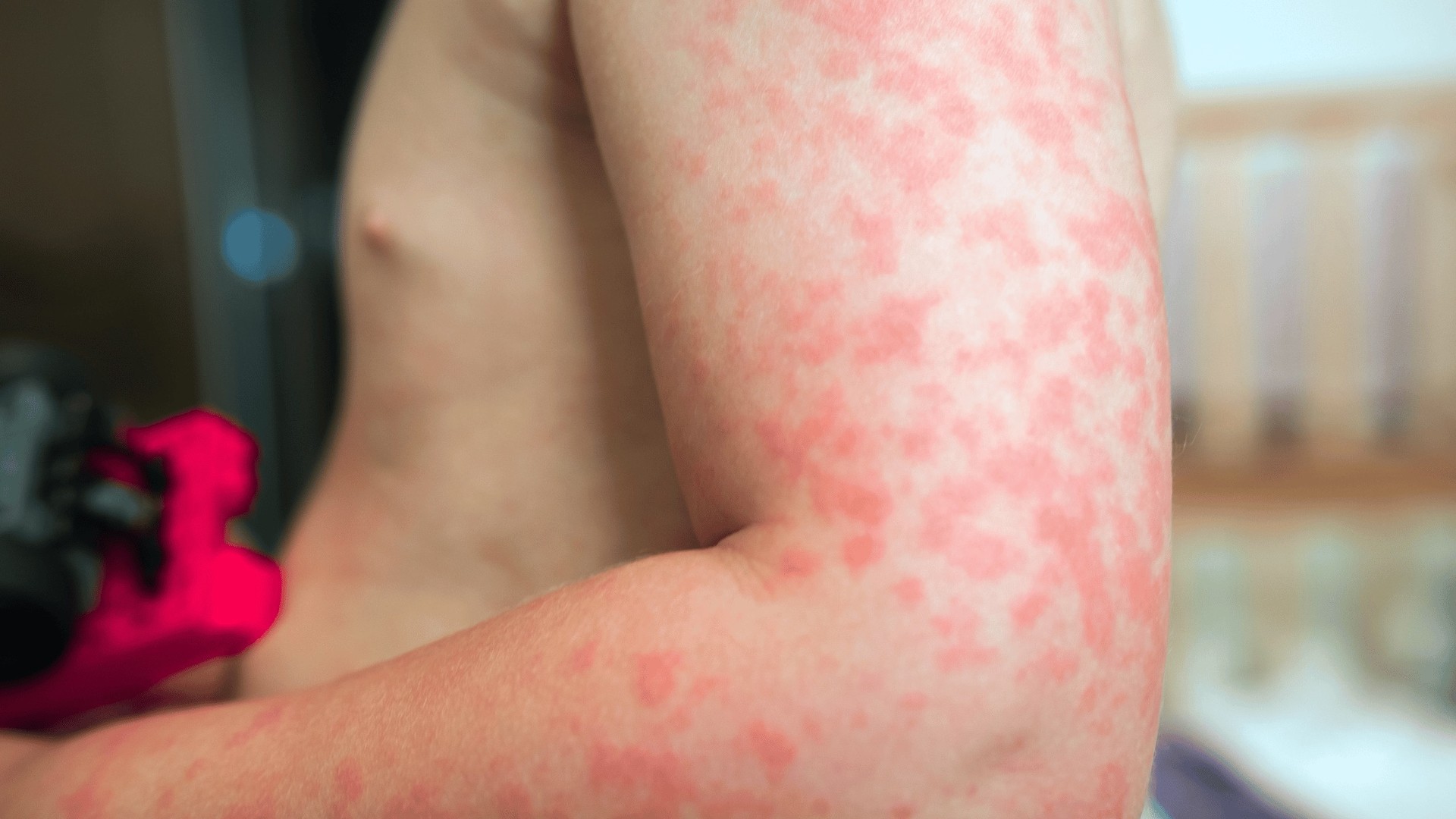 Rối loạn hệ miễn dịch là gì? Những thông tin cần biết - Trung tâm Tiêm ...