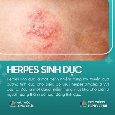 Herpes sinh dục là gì? Nguyên nhân, triệu chứng và cách điều trị - Trung tâm Tiêm chủng Long Châu