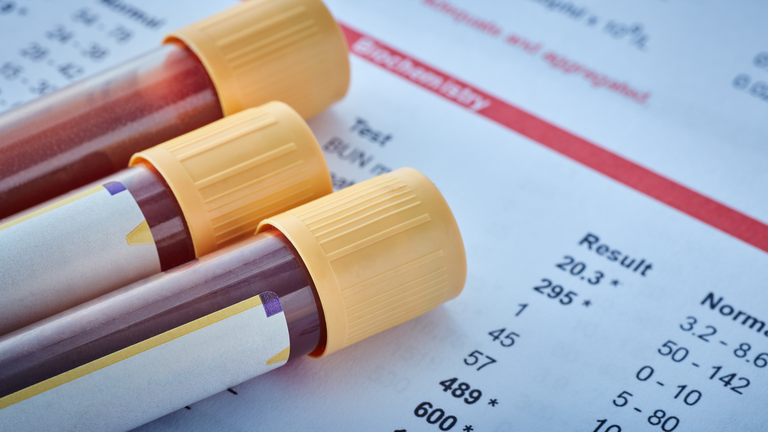 Test lao tiềm ẩn: Những điều cần biết và hướng xử lý